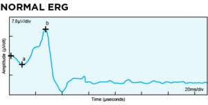 SARDS Causes and Treatment | AVCVA Virtual Library