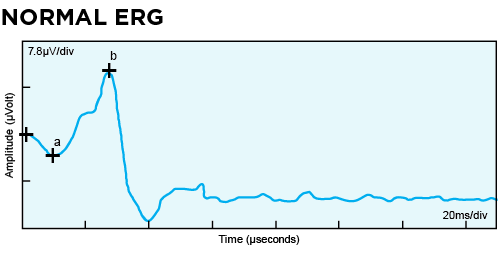 AVCVA_SARDS Brochure_Normal ERG - Animal Vision Center of VA